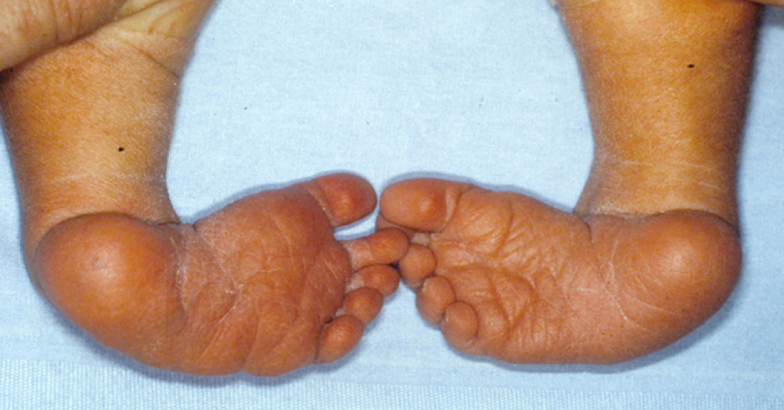 PIED BOT : ORIGINES, SYMPTÔMES DISTINCTIFS ET COMPLICATIONS – Podoways