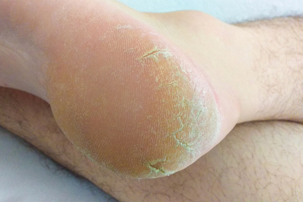 Pourquoi enlever la corne des pieds ? Causes et bienfaits. – Podoways